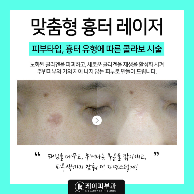 부산피부과 여드름흉터 치료도트필링tca도트필 부작용은 네이버 블로그